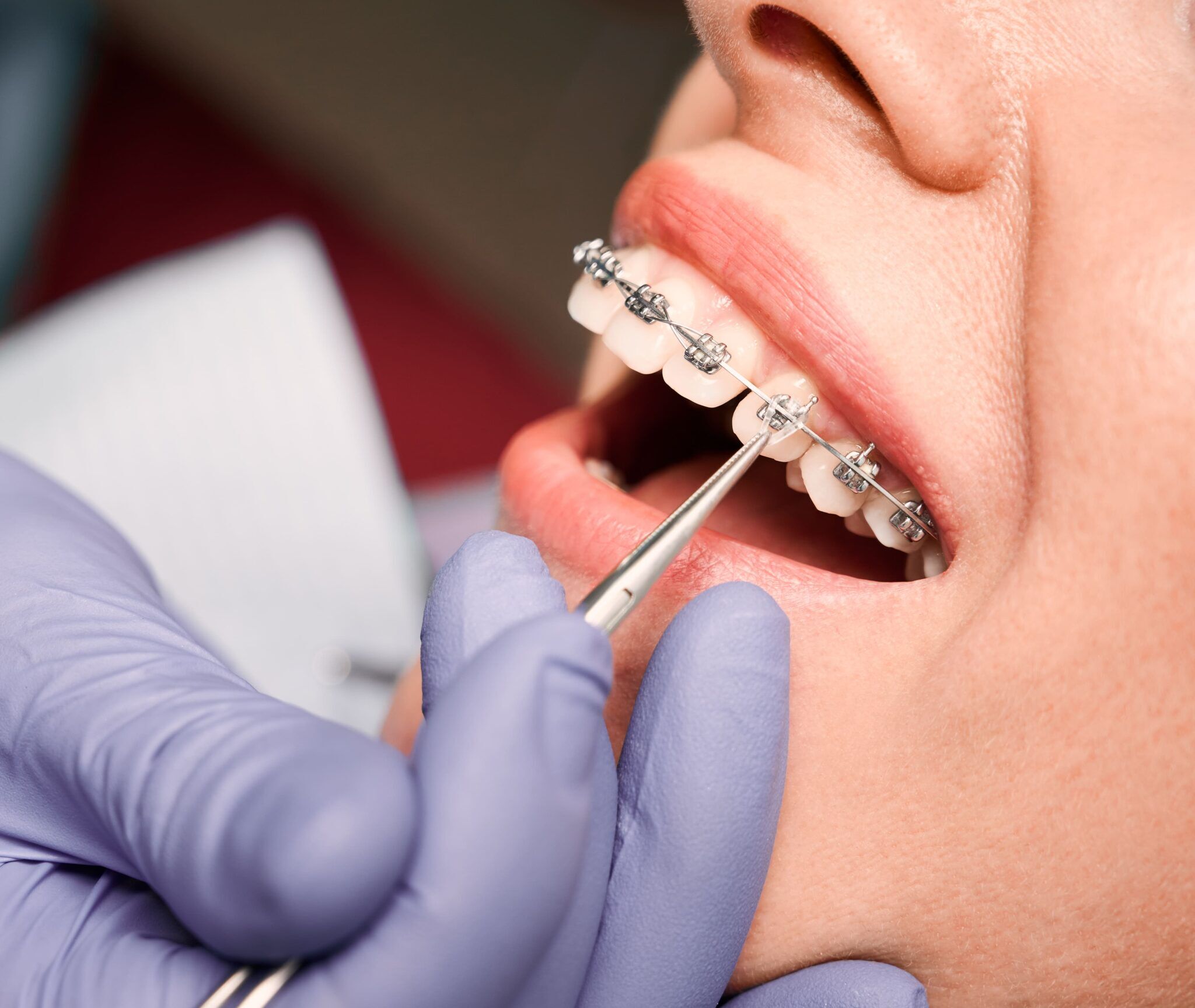 Broken Brackets at Home: What to Do Before You See Your Orthodontist ...